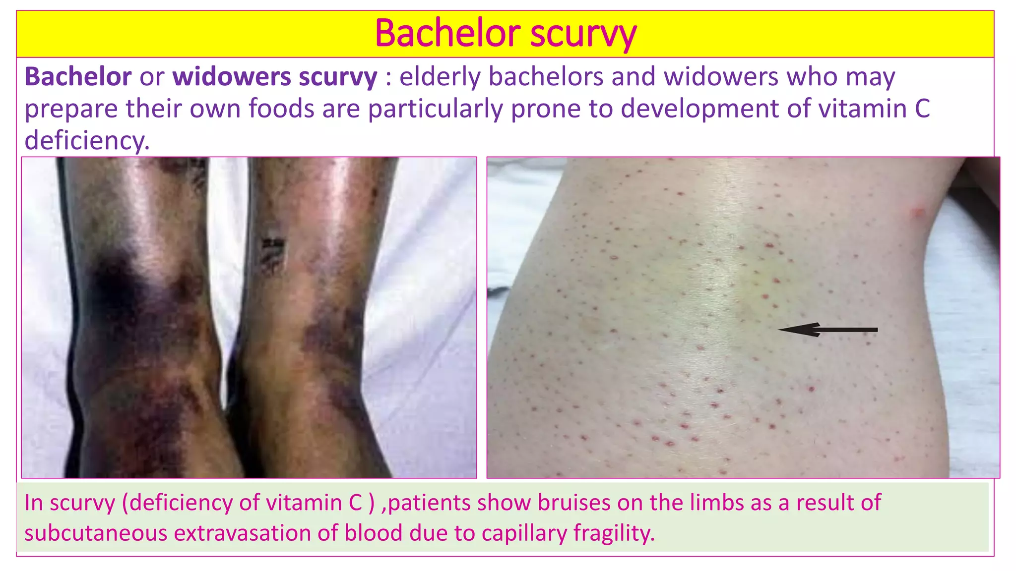 Scurvy (deficiency of vitamin C) | PDF