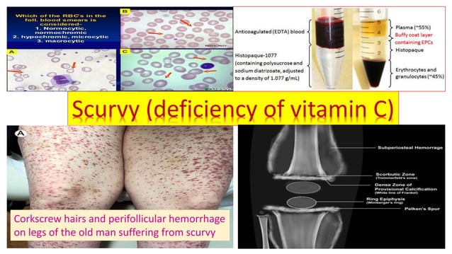 Scurvy (deficiency of vitamin C) | PDF