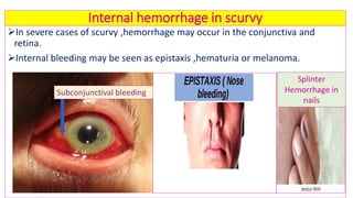 Scurvy (deficiency of vitamin C) | PDF