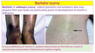 Scurvy (deficiency of vitamin C) | PDF