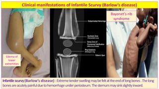 Vitamin C Deficiency Bones