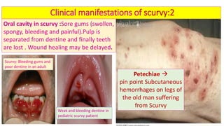 Bleeding Gums Scurvy