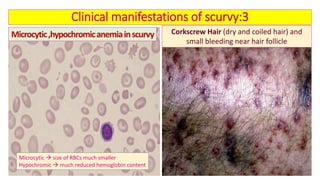 Scurvy (deficiency of vitamin C) | PPT