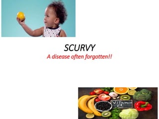 Scurvy in children | PPTX