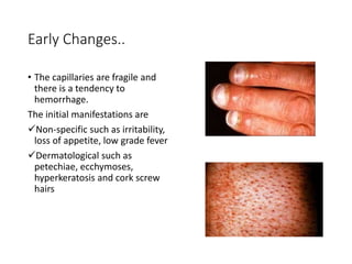 Scurvy in children | PPTX