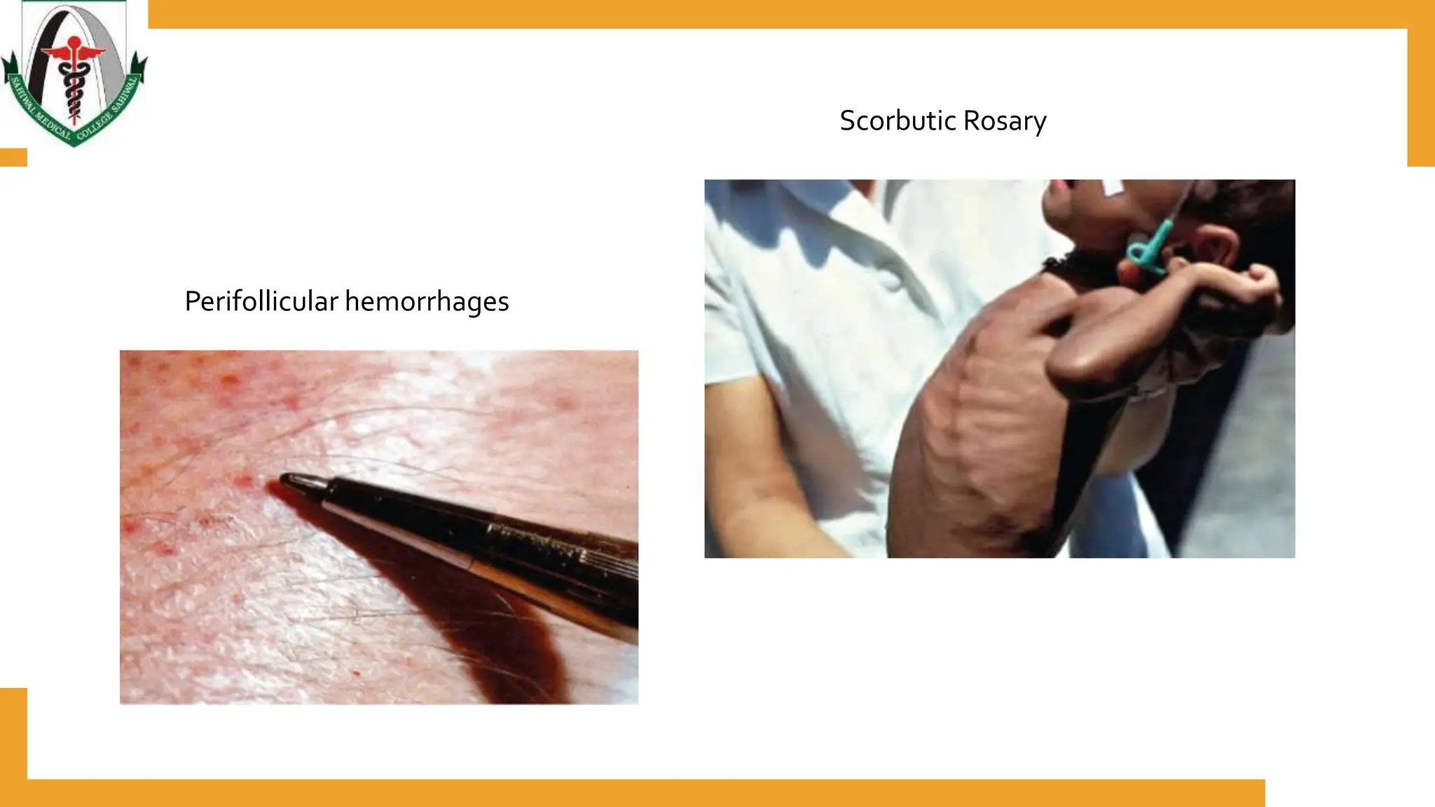 scurvy case scanario and description final.pptx