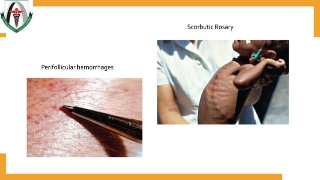 scurvy case scanario and description final.pptx | Blood Disorders ...