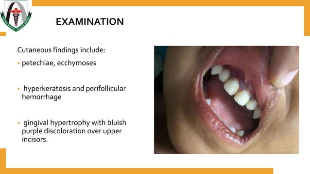 scurvy case scanario and description final.pptx | Blood Disorders | Diseases and Conditions