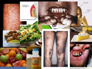 Scurvy Presentation | PPTX