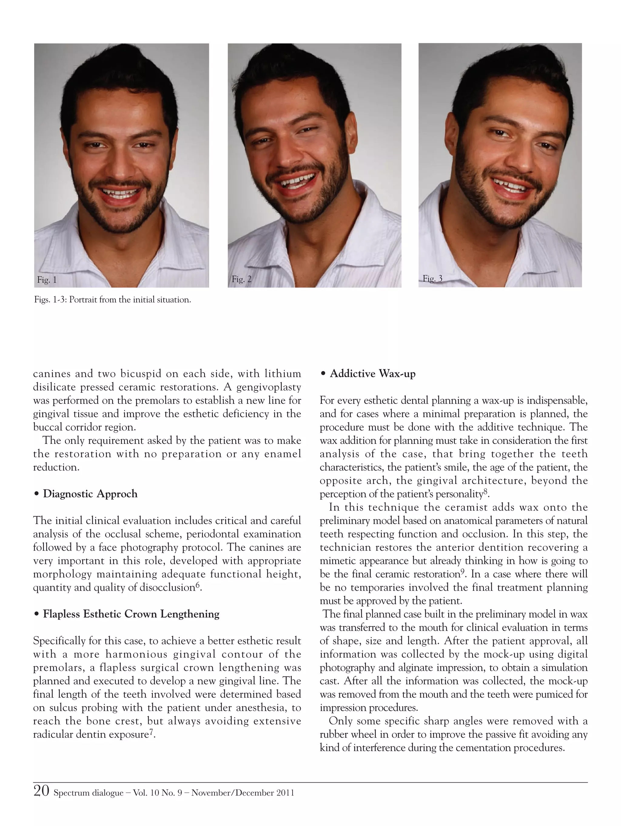 Sd v10 n9-lithium disilicate veneers-dr.adolfi | PDF
