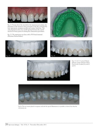Sd v10 n9-lithium disilicate veneers-dr.adolfi | PDF