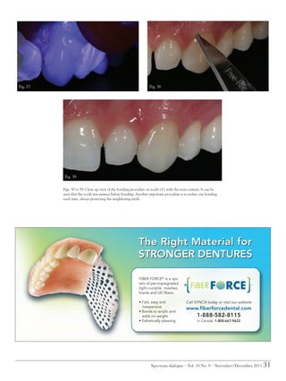 Sd v10 n9-lithium disilicate veneers-dr.adolfi | PDF