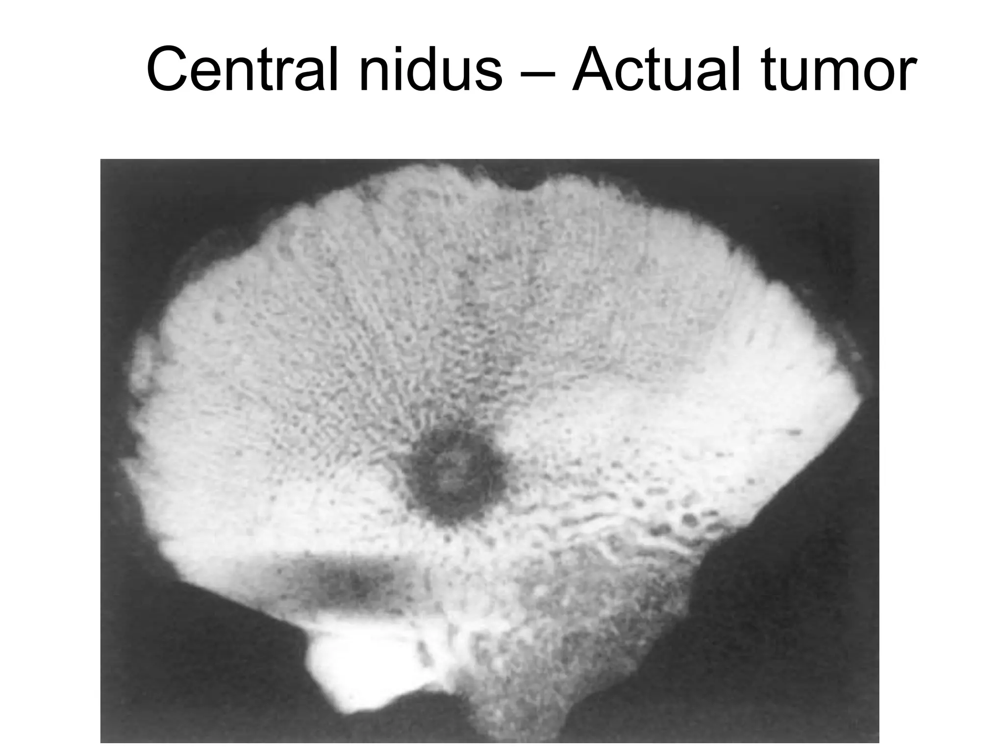 Pathology of bone tumors | PPTX