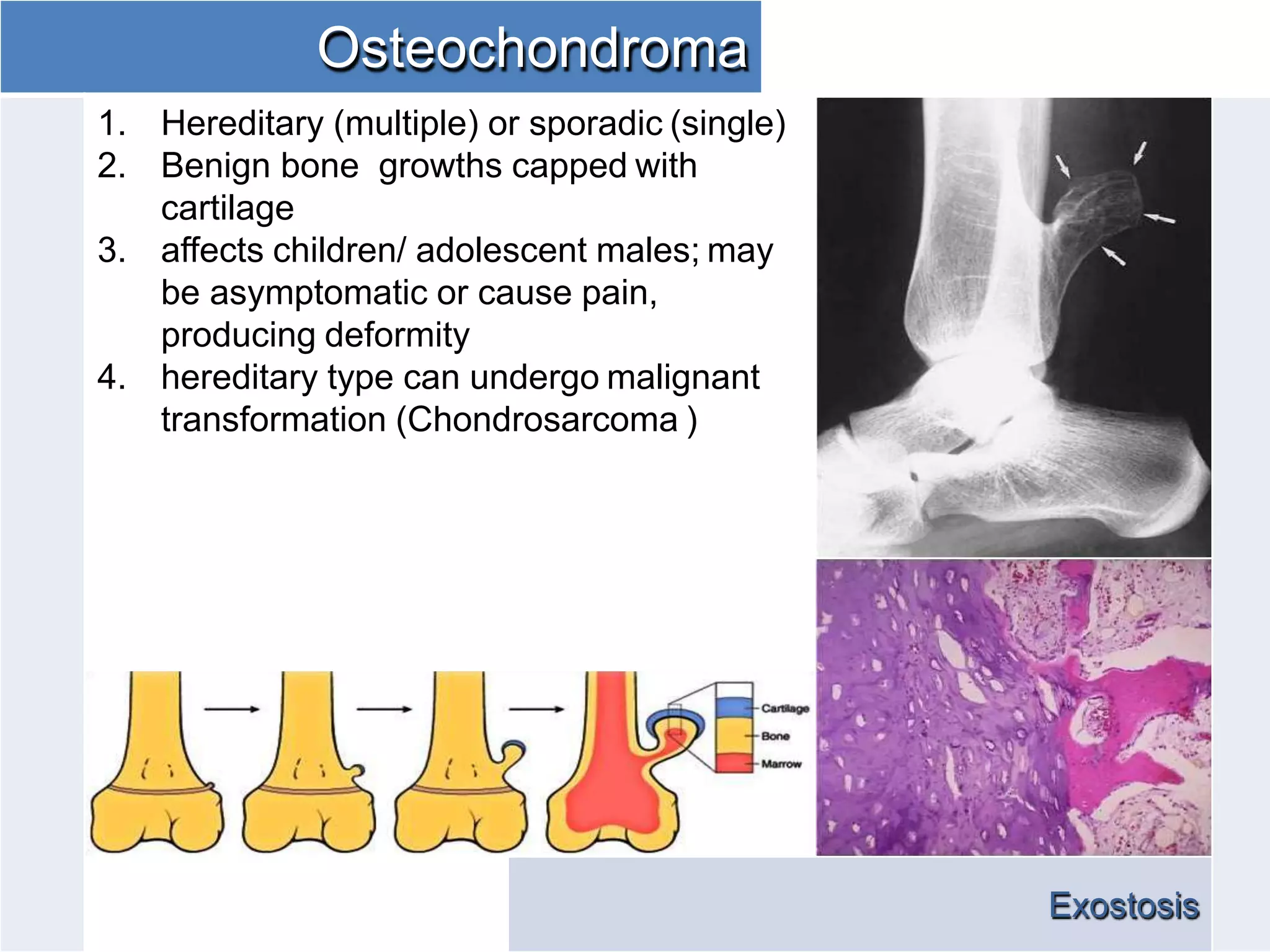 Pathology of bone tumors | PPTX