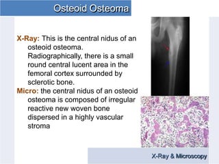 Pathology of bone tumors | PPTX