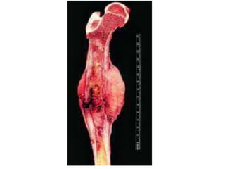 Pathology of bone tumors | PPTX