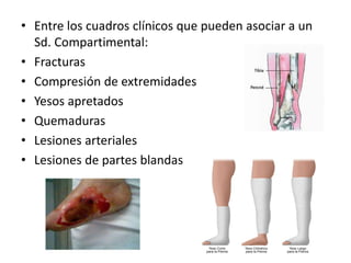 Sindrome compartimental | PPTX