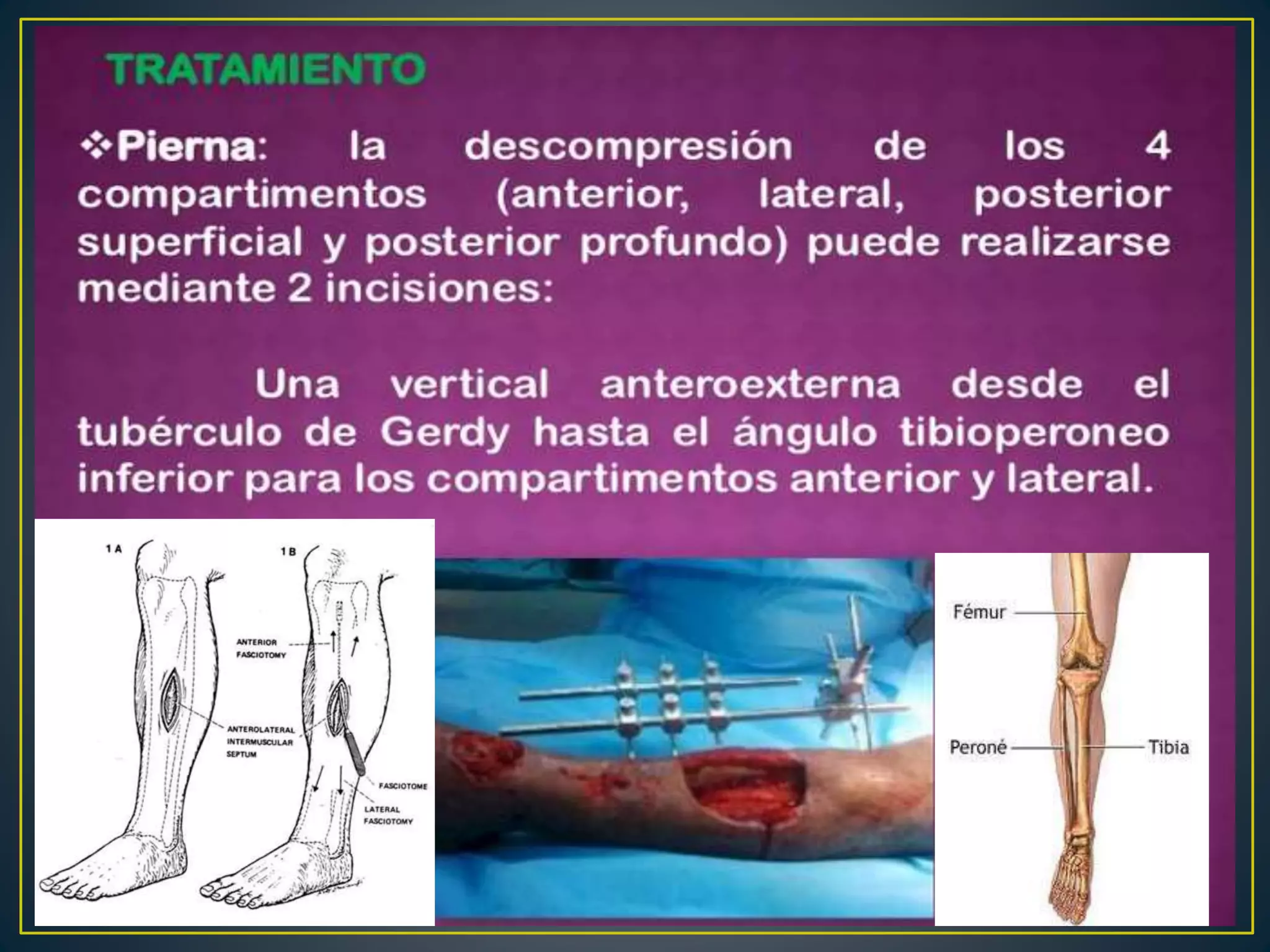 Sindrome compartimental y atrofia de sudeck | PPT