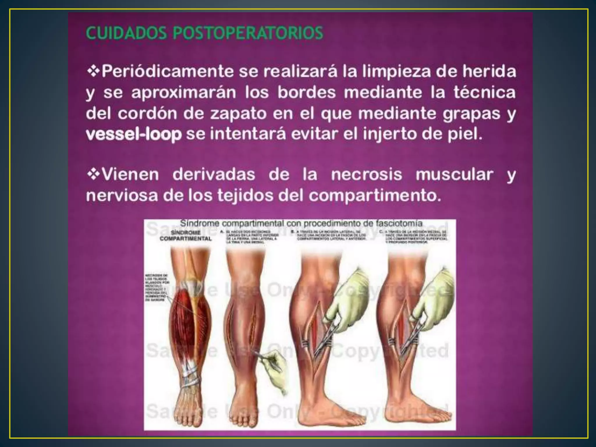 Sindrome compartimental y atrofia de sudeck | PPT