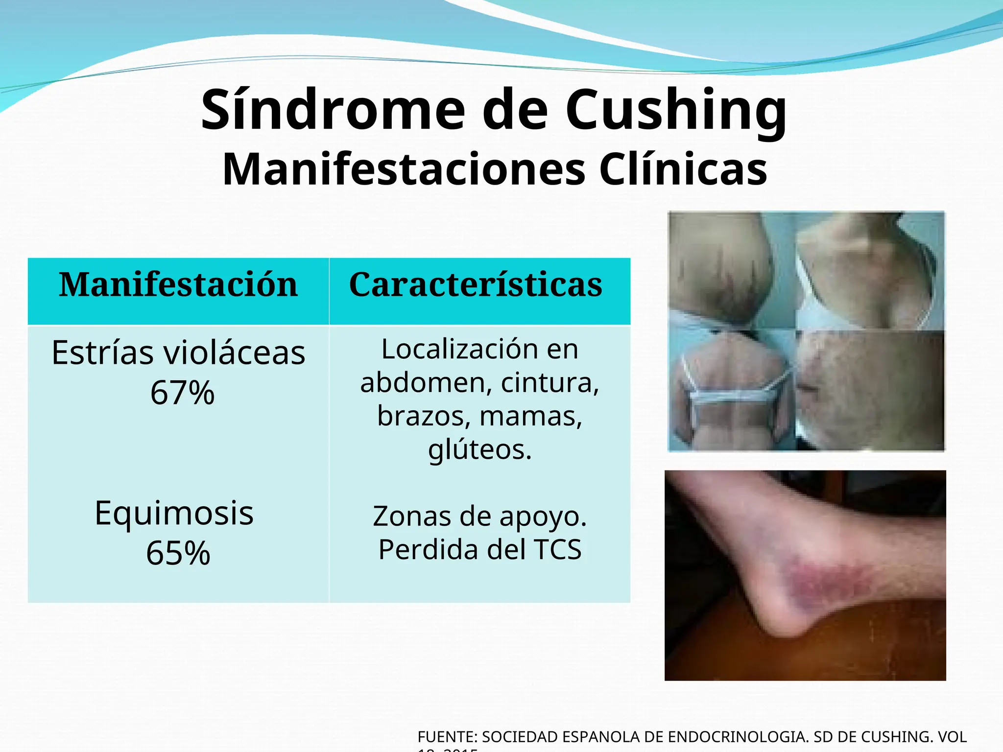 Sd Cushing fisiopatología 2017.......... | PPT