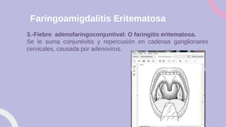 procesos inflamatorios de la Faringe.pptx