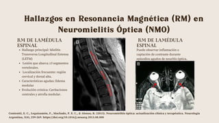 Sindrome de Devic o neuromielitis óptica | PDF