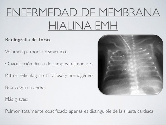 Sd dificultad respiratoria aguda RN