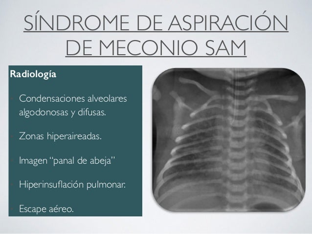 Sd dificultad respiratoria aguda RN