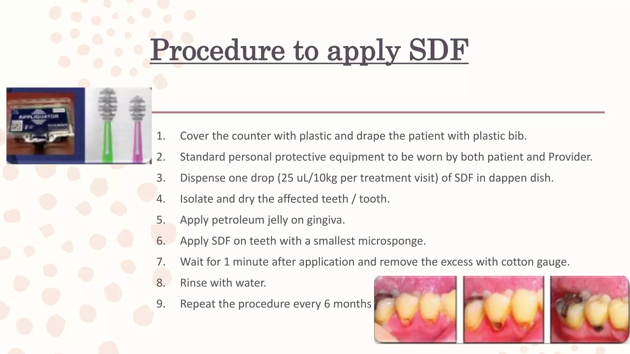 SILVER DIAMINE FLUORIDE (SDF) | PPTX