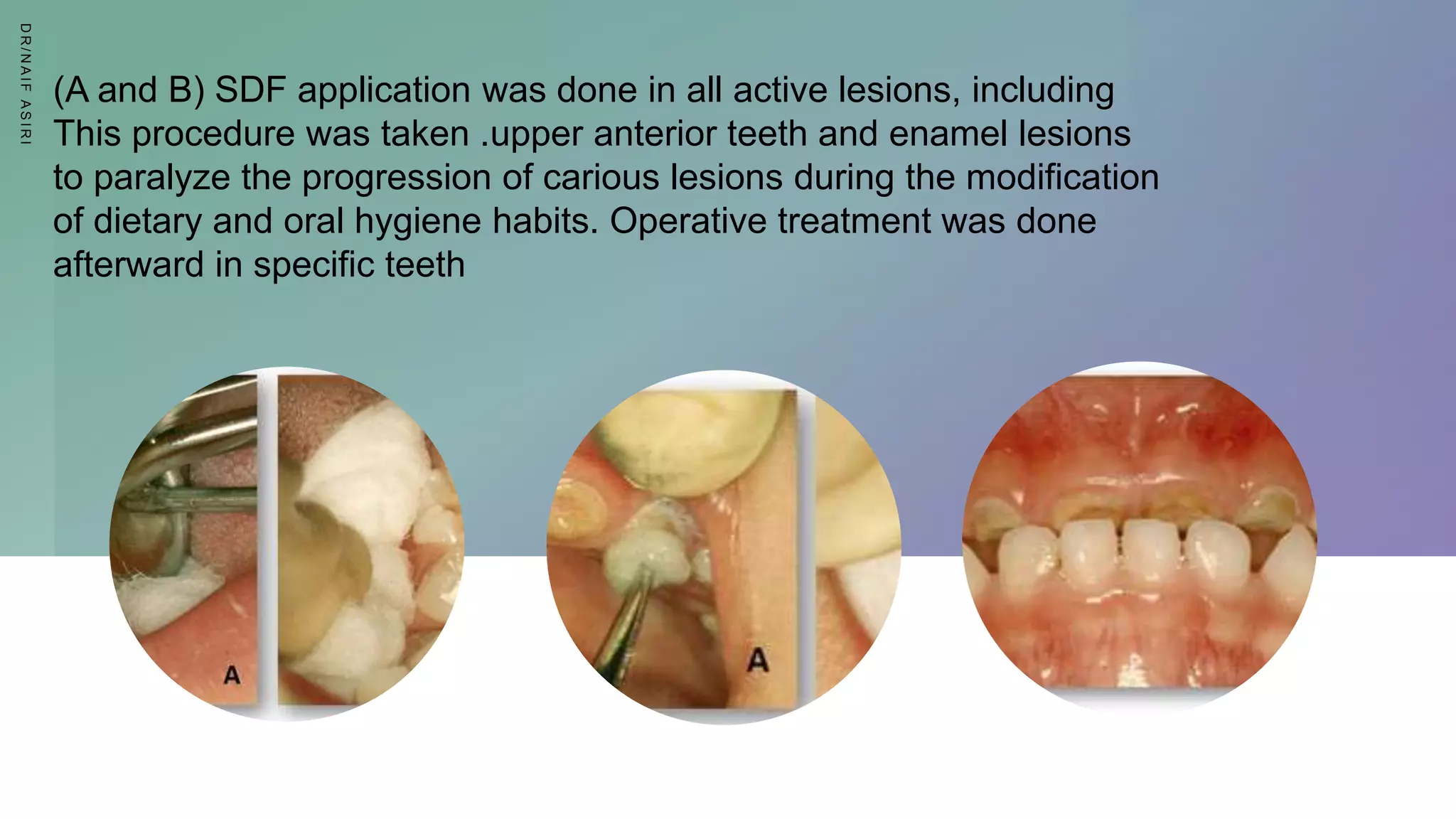 silver diamine fluoride -SDF -Pediatric dentistry | PPTX