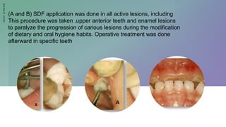 silver diamine fluoride -SDF -Pediatric dentistry | PPTX