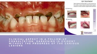 silver diamine fluoride -SDF -Pediatric dentistry | PPTX