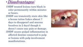 Silver Diamine Fluoride | PPTX