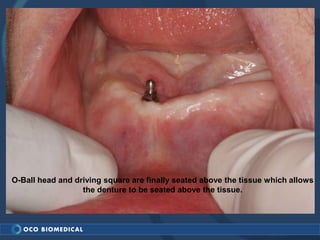 OCO Biomedical SDI Case | PPTX