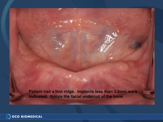 OCO Biomedical SDI Case | PPTX