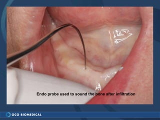 OCO Biomedical SDI Case | PPTX