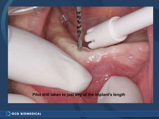 OCO Biomedical SDI Case | PPTX