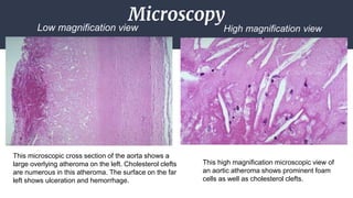 Atherosclerosis and it’s complications | PPTX | Heart and ...