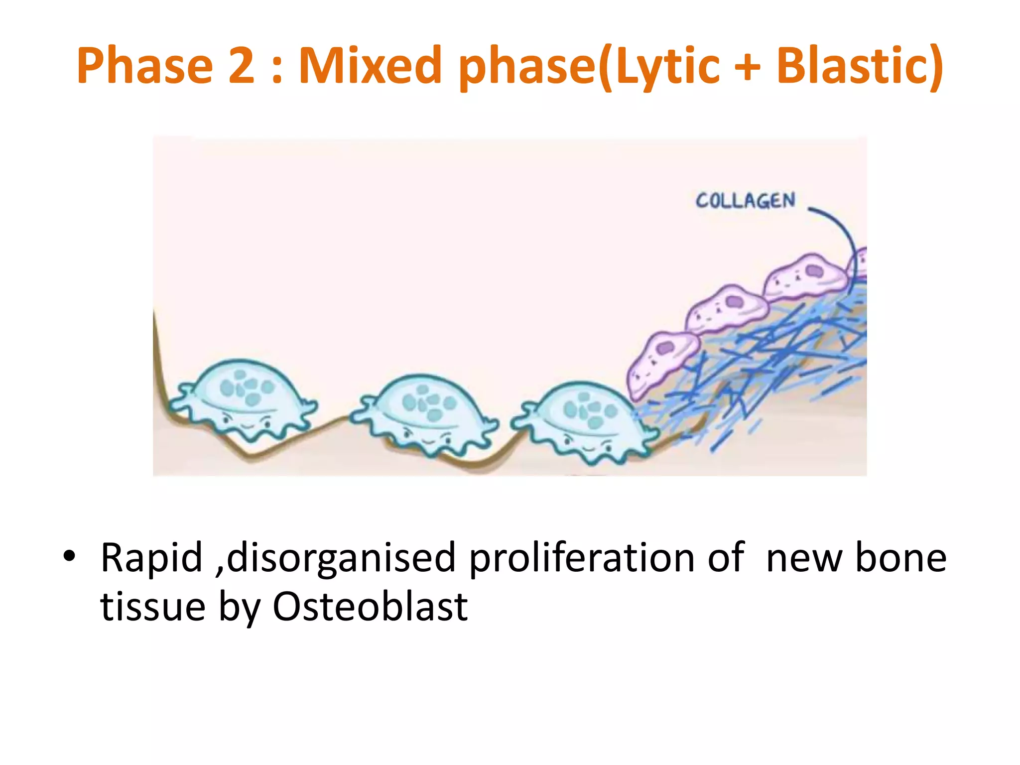 paget's disease of bone | PPTX