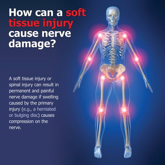 FAQ spine and soft tissue injuries | PDF