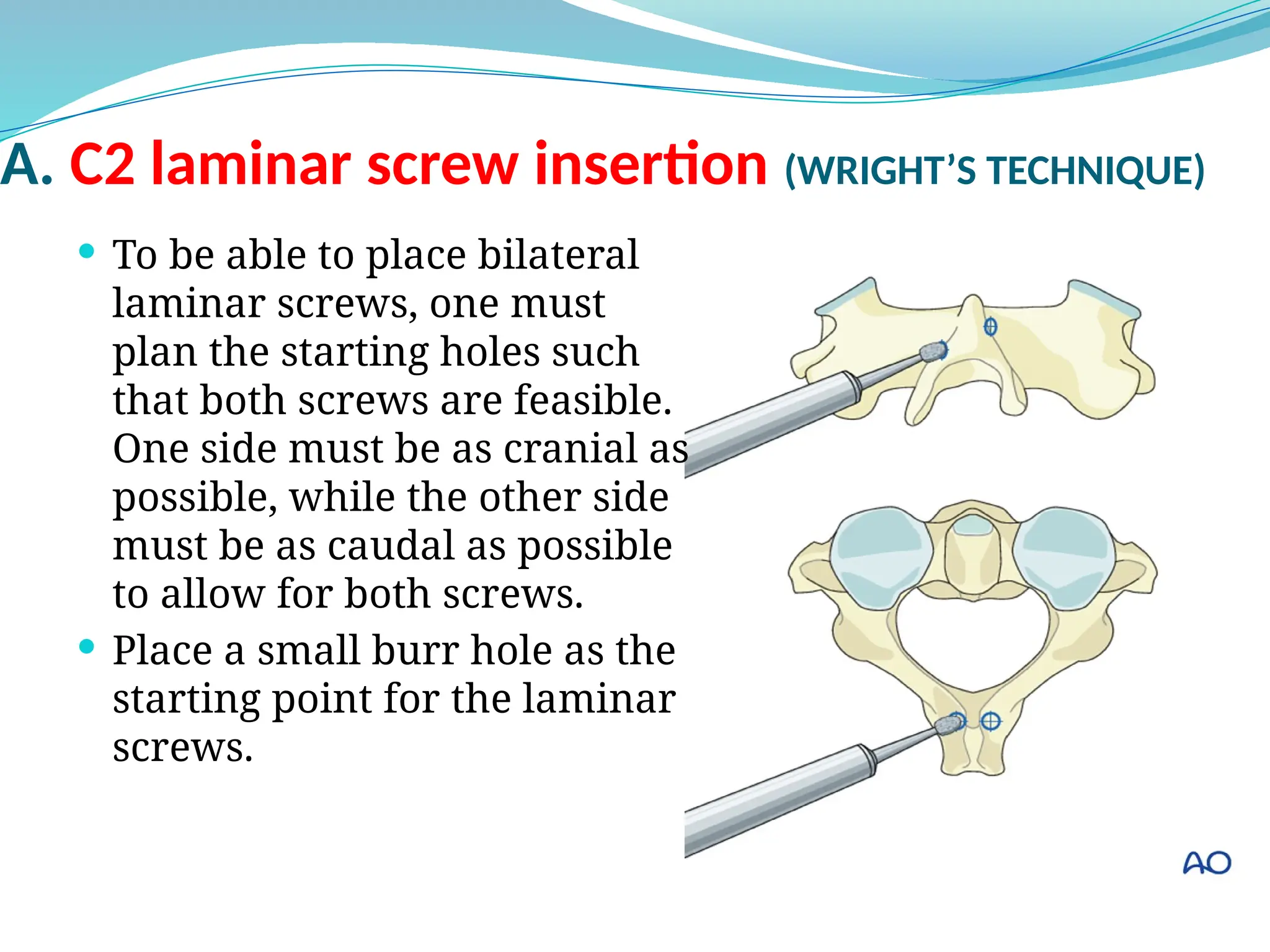 Posterior pedicular spine screws entry points | PPSX