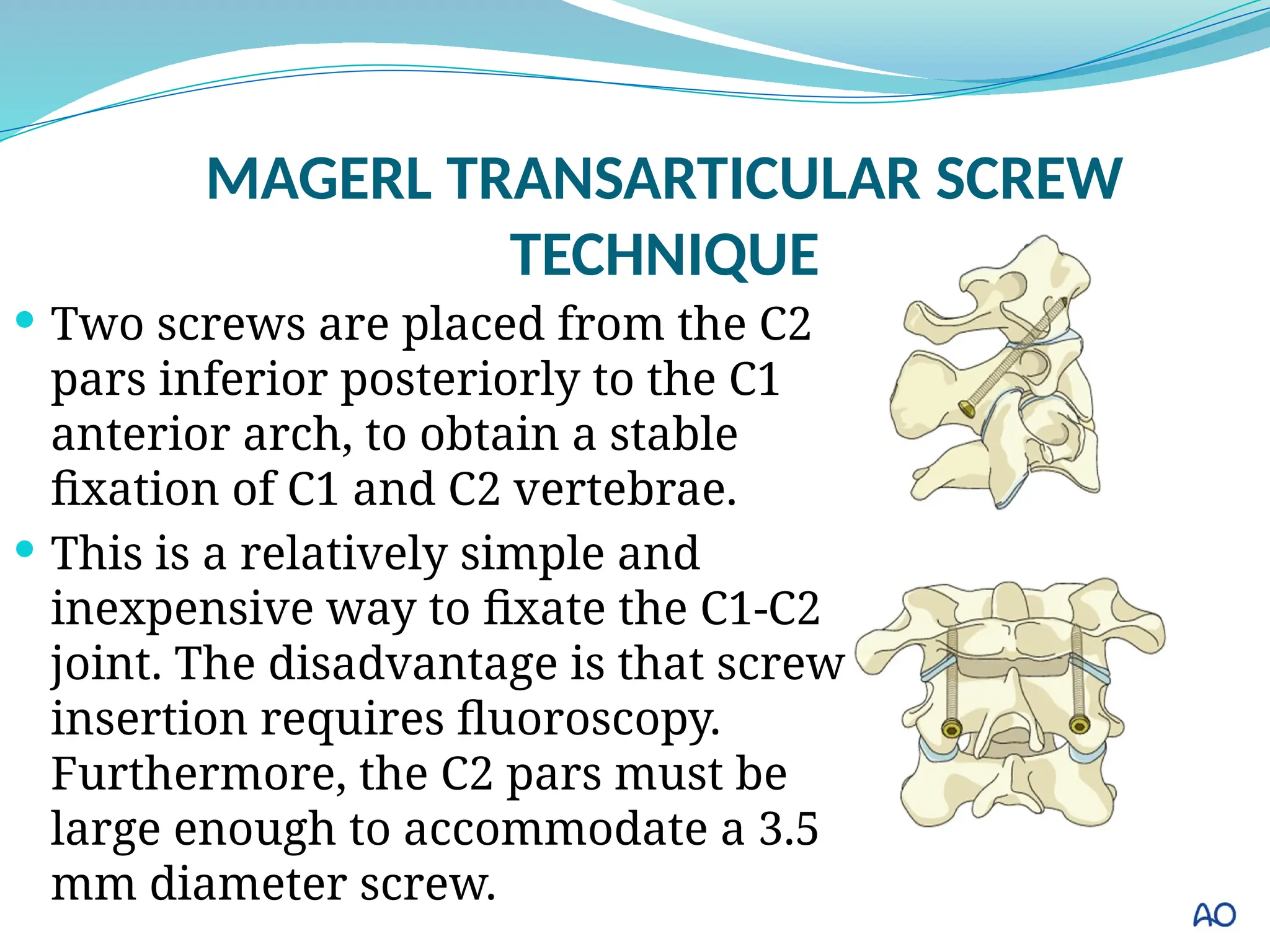 Posterior pedicular spine screws entry points | PPSX