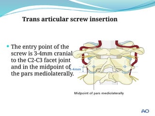 Posterior pedicular spine screws entry points | PPSX