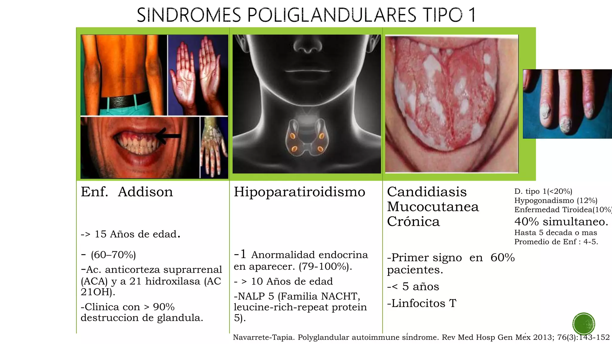 Sindrome poliglandular autoinmune | PPTX | Thyroid Disorders ...