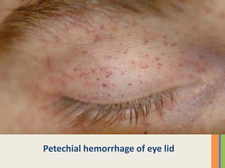 Petechiae Eye Strangulation