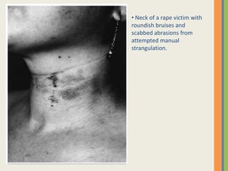 Choking Bruises