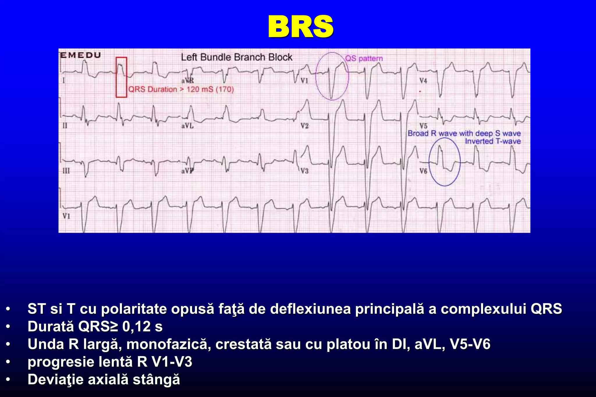Sindroame coronariene cute (SCA) | PPT