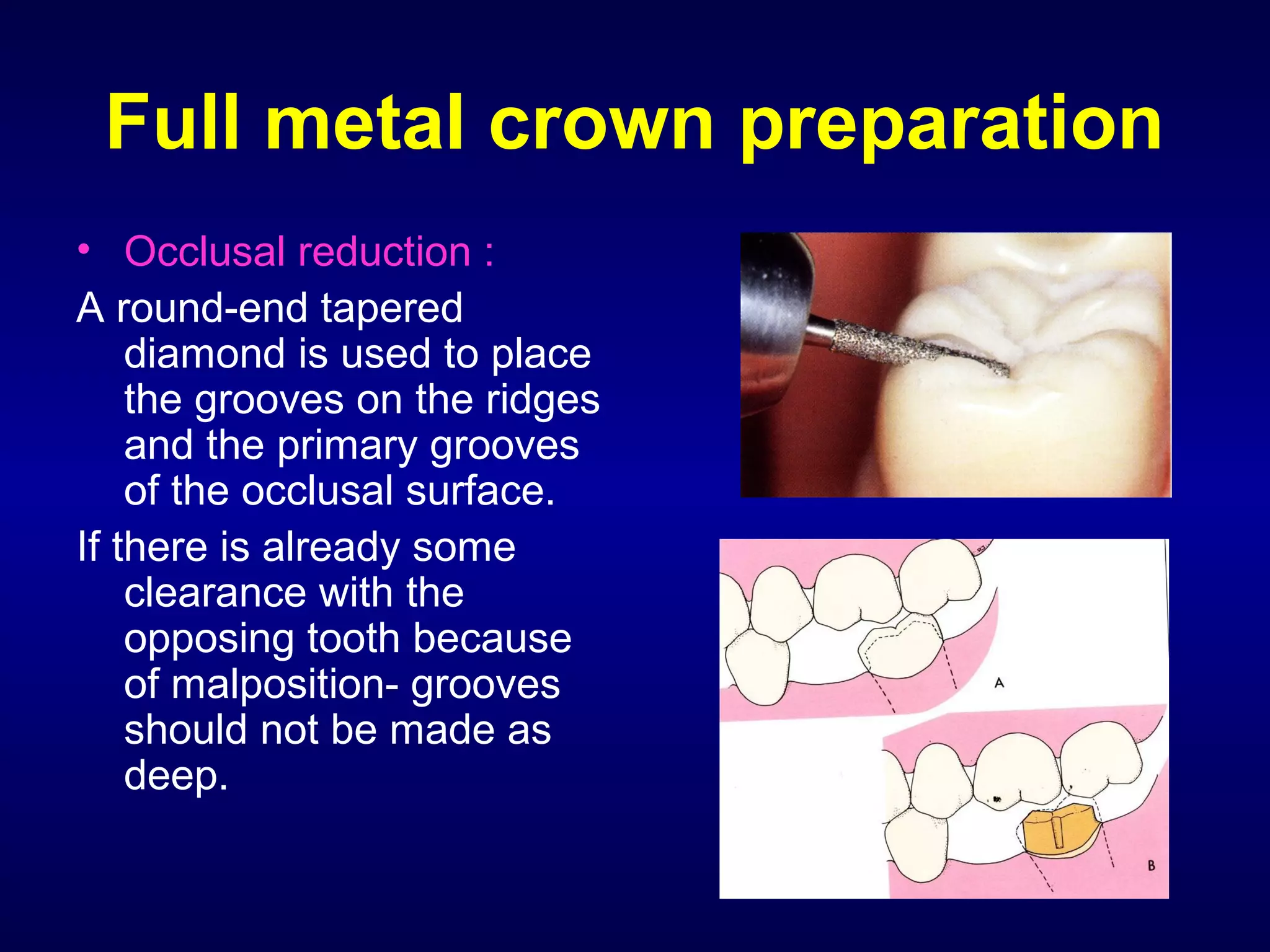 prin of tooth prep | PPT