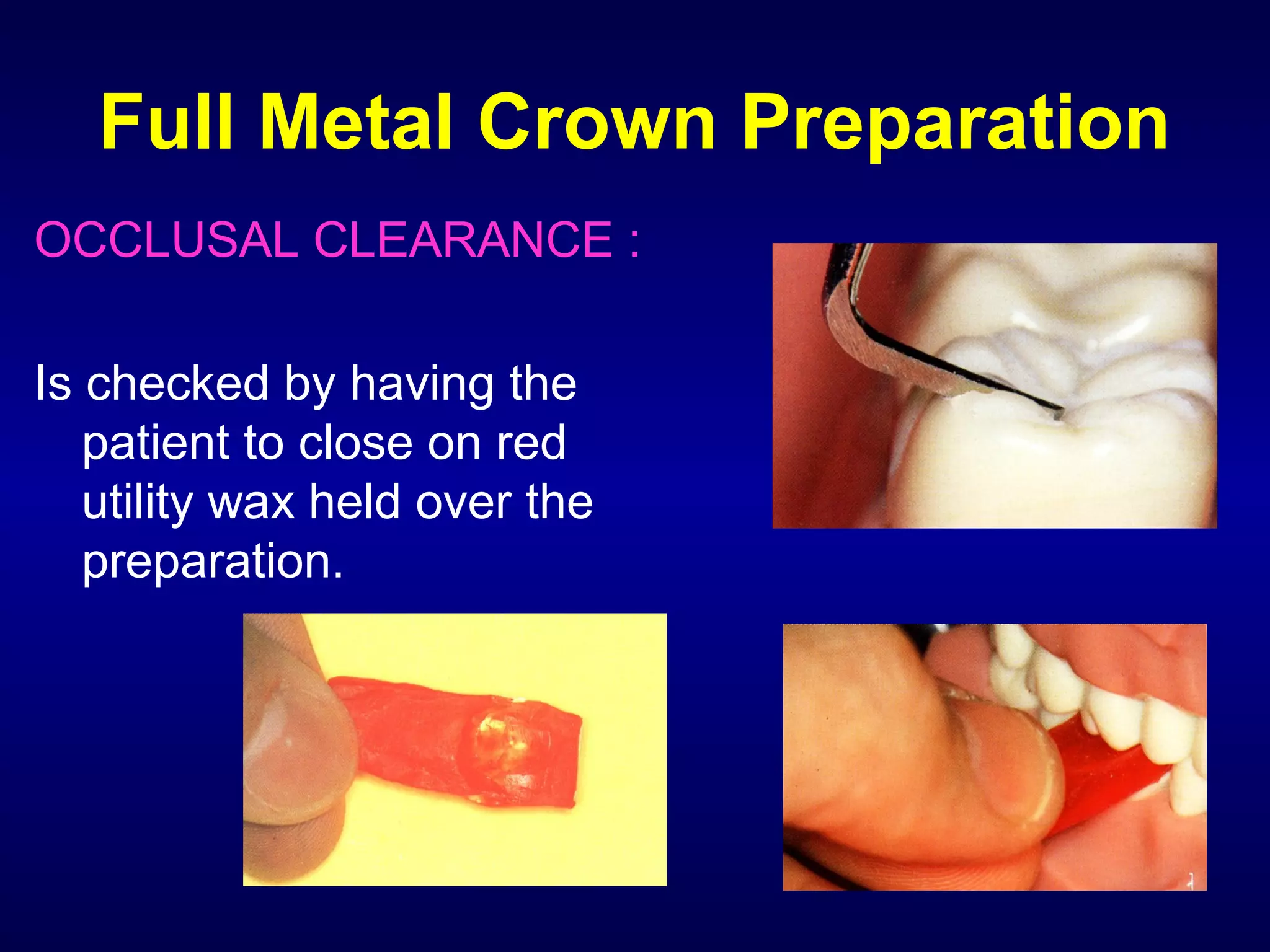 prin of tooth prep | PPT