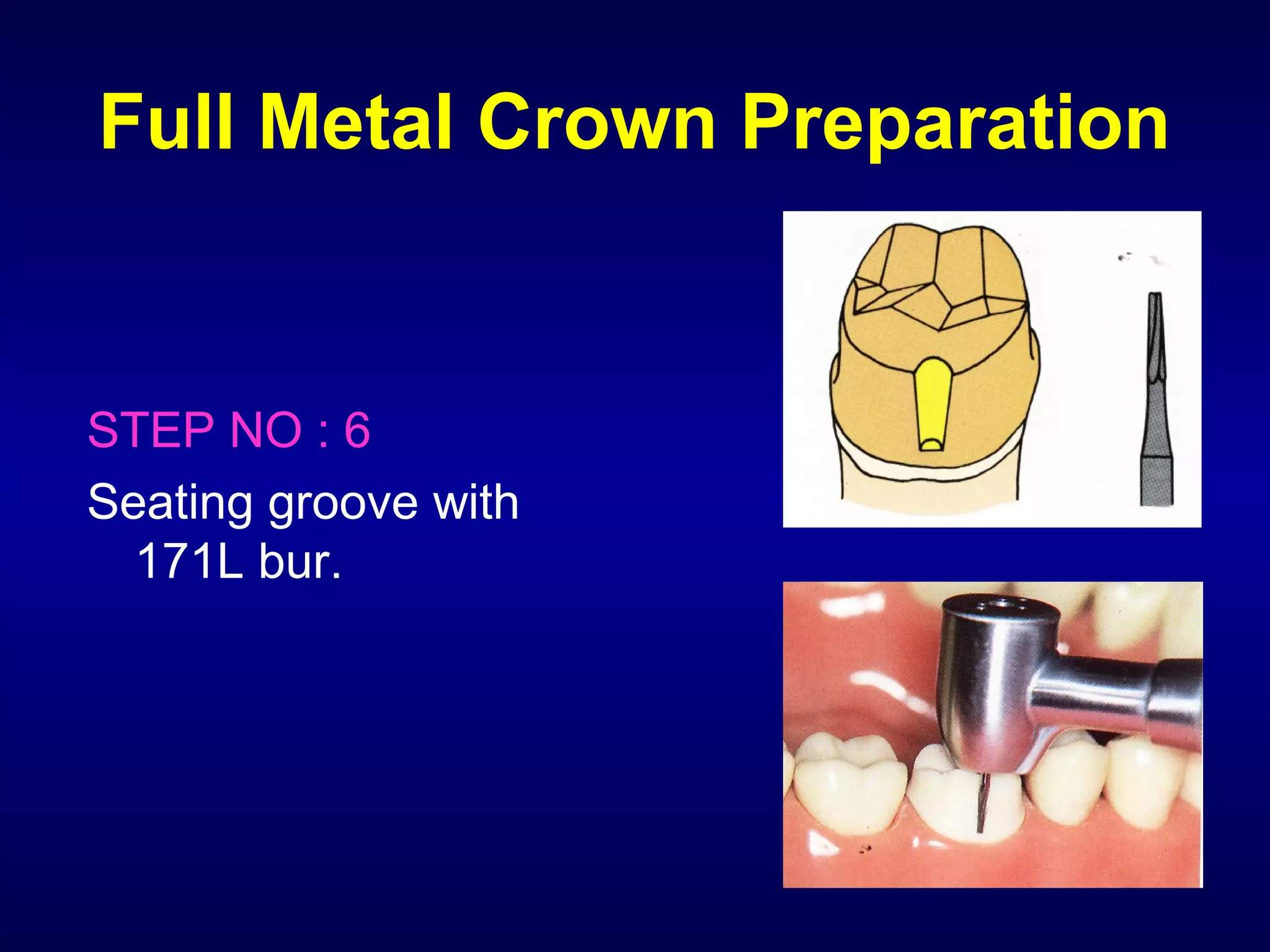prin of tooth prep | PPT